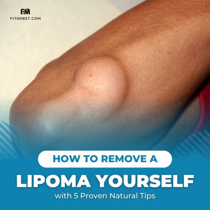 How to Remove a Lipoma Yourself with 5 Proven Natural Tips